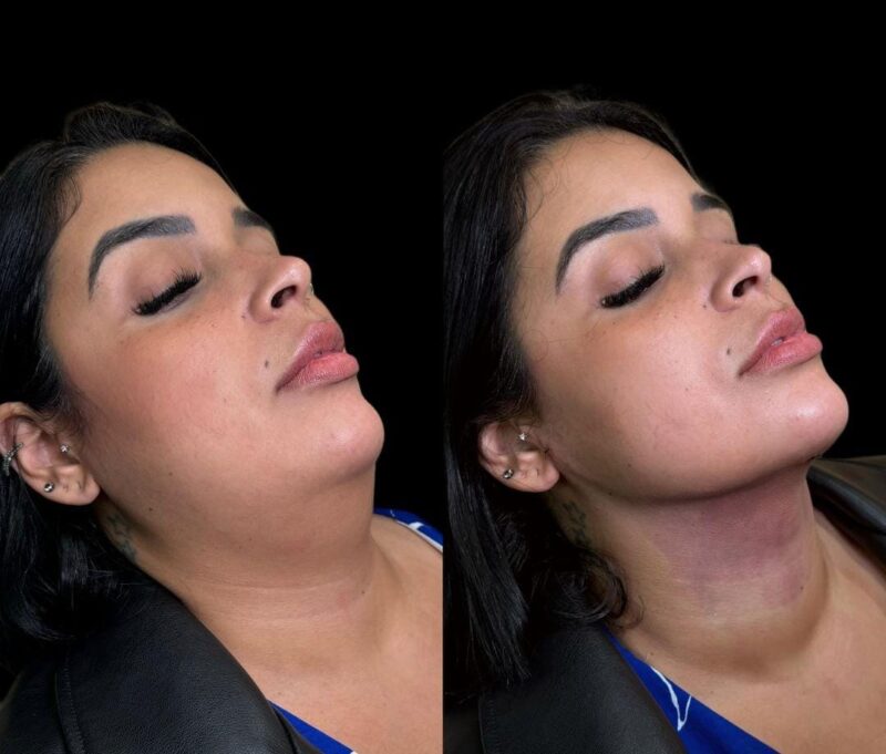 Lipoaspiração de Papada: O que é, Valor, Procedimento