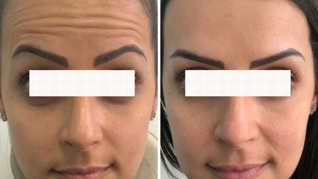 Botox no Rosto: Antes e Depois - Fotos Reais, Pré e Pós Cirurgia